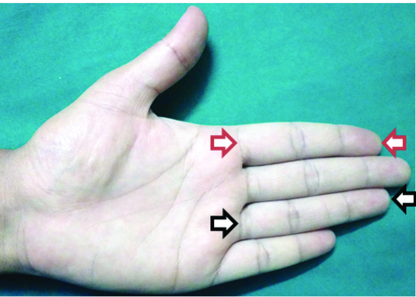 Human hand showing landmarks of hand length (AB) and hand breadth (CD).