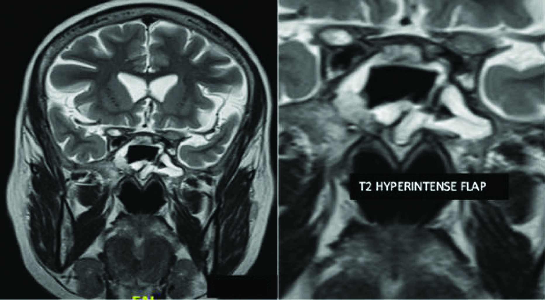However, previous studies have shown that complications of flap ...