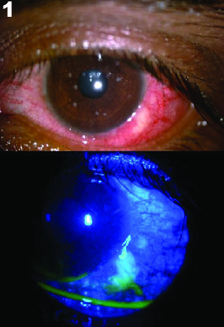 Phlyctenulosis