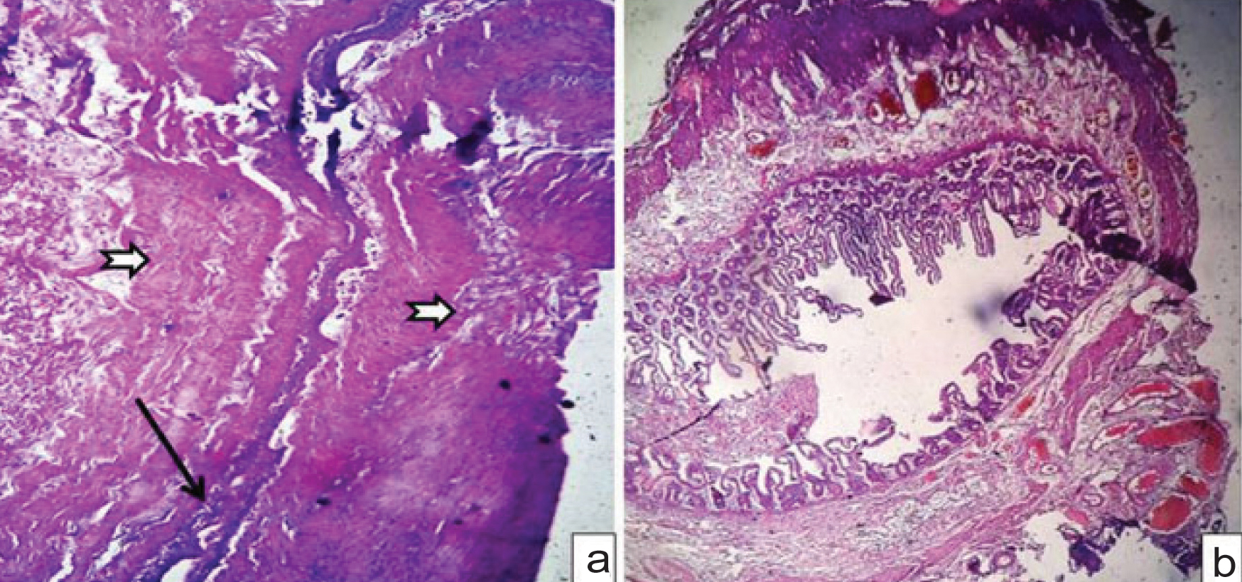 Apple Peel Atresia Usmle