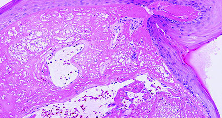 Benign vocal cord polyp in the right vocal cord (H&E stain, 40X).