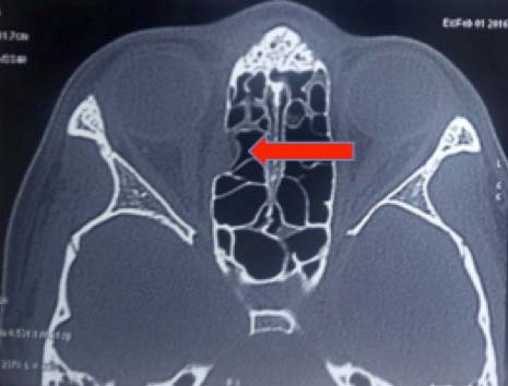 Axial cut showing fracture of medial orbital wall with medial rectus ...