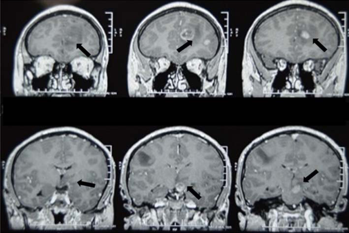 MRI of brain showing multiple rounded peripherally enhancing lesions in ...
