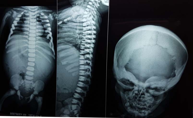 Erlenmeyer Flask Deformity Metaphyseal Flaring Is A Radiological Sign