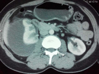 In view of subcapsular haematoma, patient was further worked up for ...