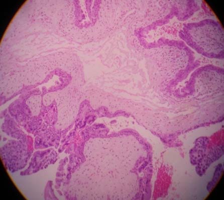 Specimen of complete mole showing grape like vesicle.