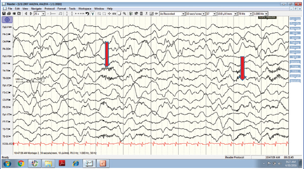 EEG showing delta brush pattern.