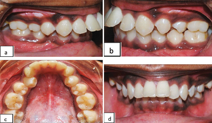 A fixed orthodontic treatment with extraction of first premolars on all ...