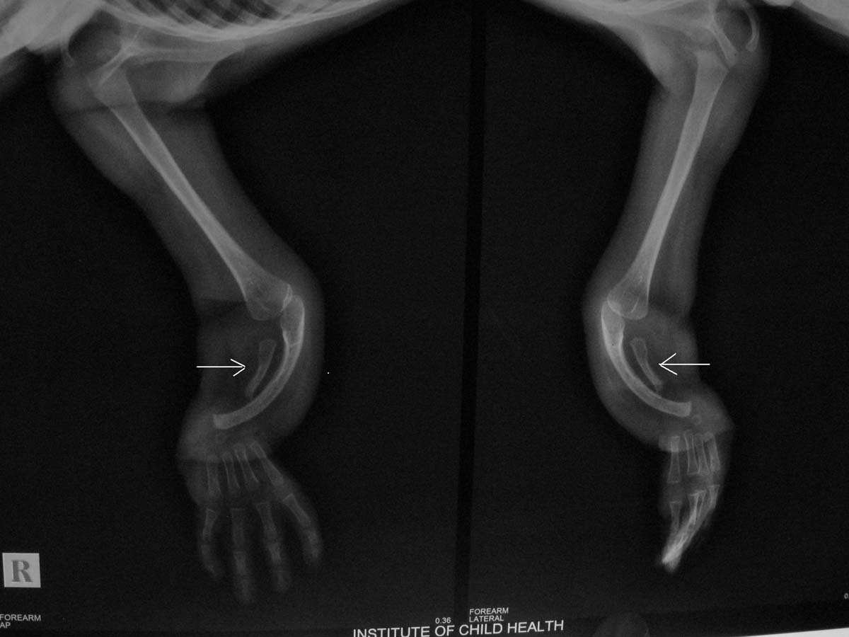 Ectrodactyly X Rays
