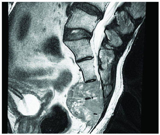 MRI image showing a well-defined lobulated sacral mass.