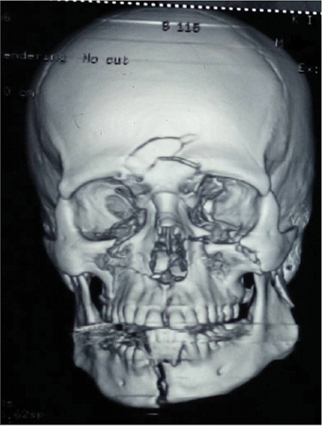 3D reconstruction CT, showing pan facial fracture involving upper ...