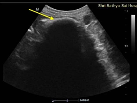 USG abdomen: Curvilinear echogenic mobile shadow in the stomach with ...