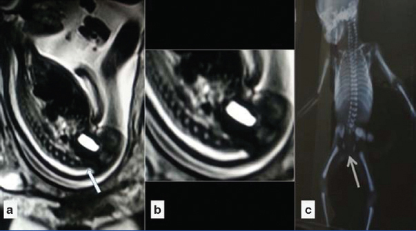 a) Sagittal HASTE sequence and; b) Magnified view show absence of ...