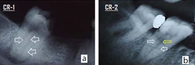 Internal Oblique Ridge Radiograph