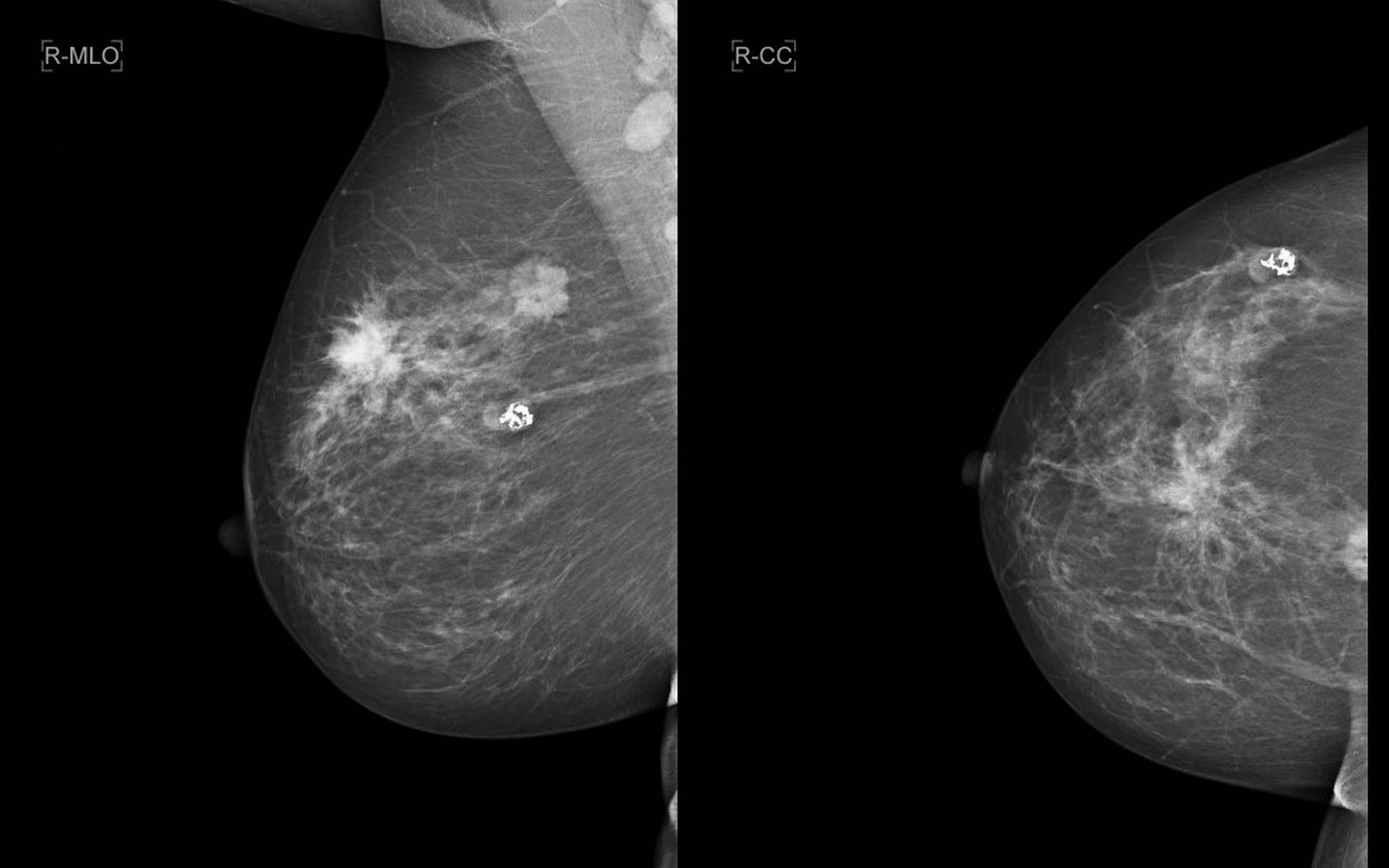 a). Right breast mediolateral oblique; b) craniocaudal views reveal two ...