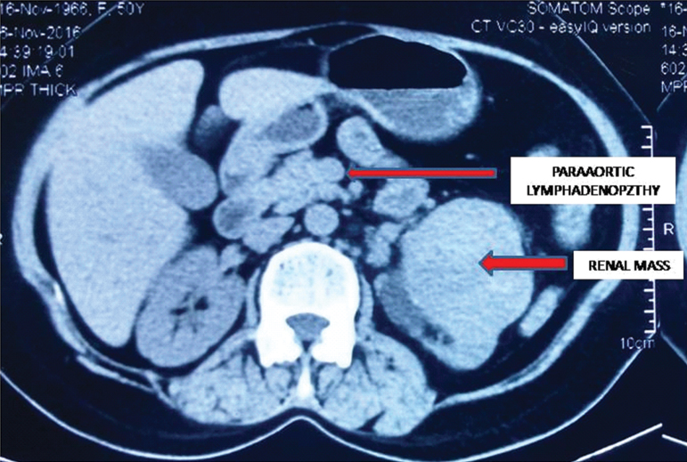 CECT showing renal mass with multiple paraaortic lymphadenopathy;