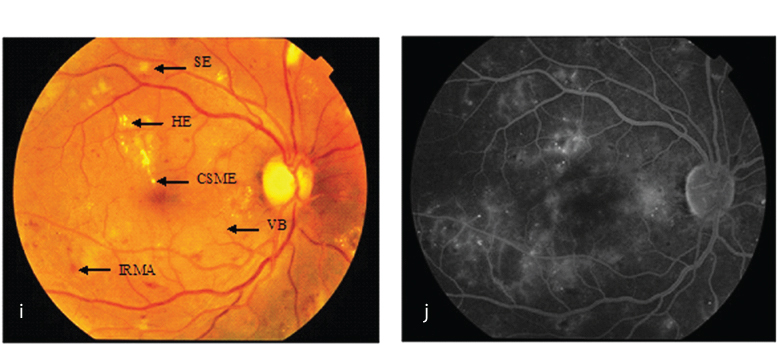 Representative picture of PDR: k) Fundus photo of 72-year-old male ...