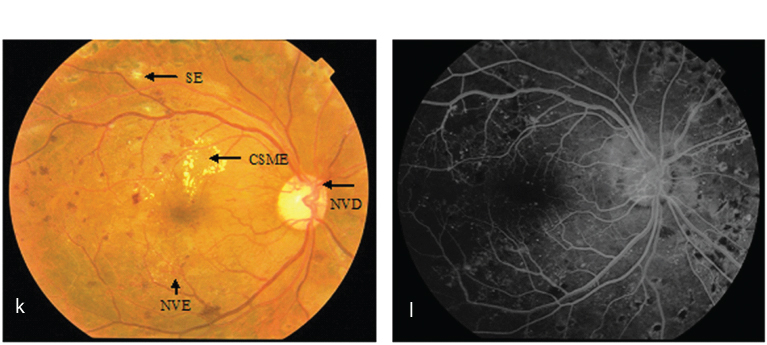 Representative picture of PDR: k) Fundus photo of 72-year-old male ...