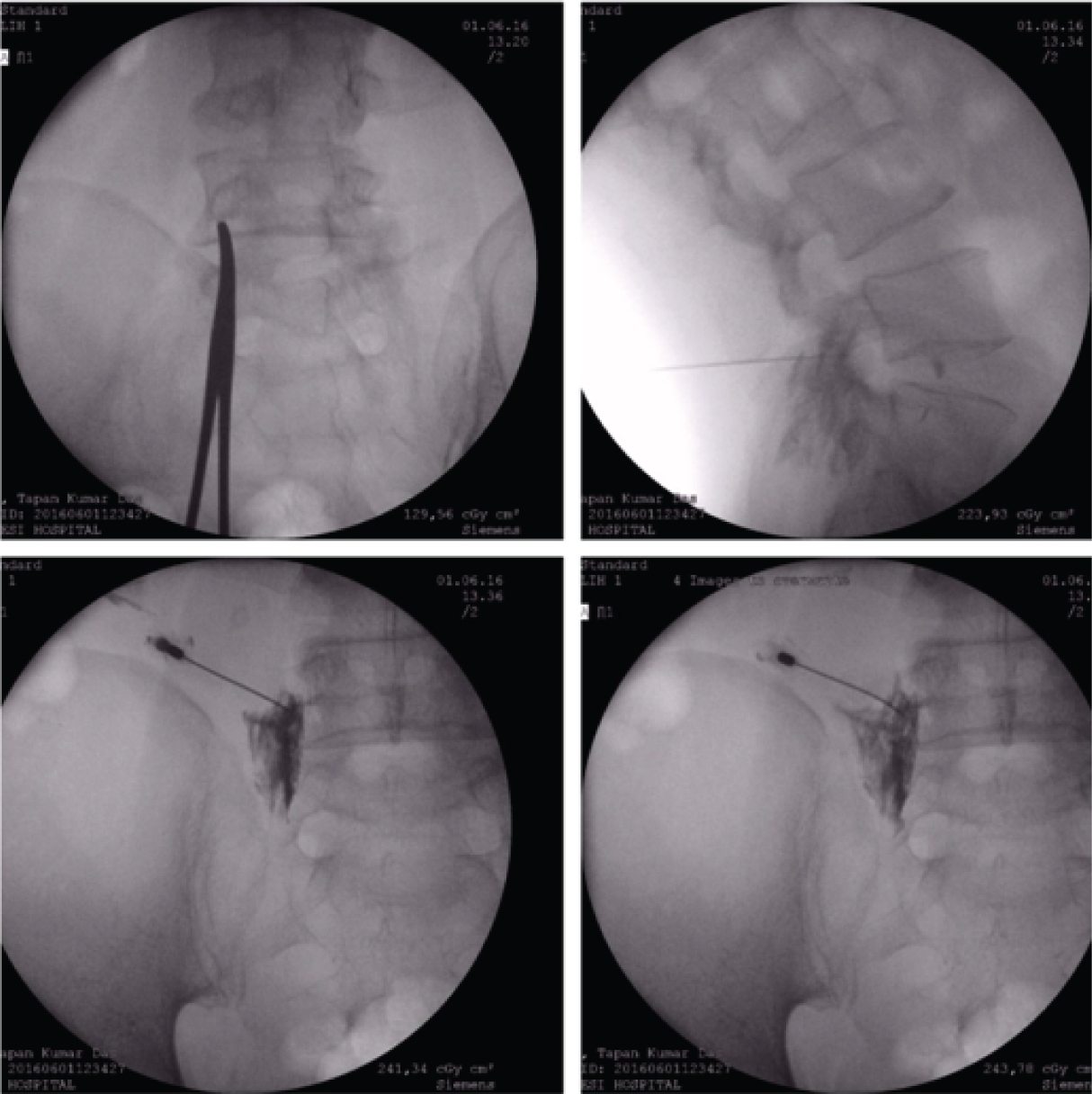 Confirmation of Epidural Steroid Injection