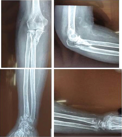 Preoperative radiograph showing: fracture of proximal ulna with ...