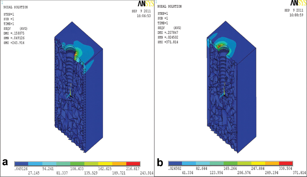 Buttress thread design: Stress patterns generated within the bone at ...