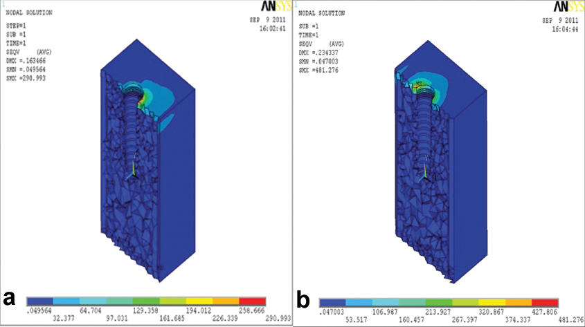 Hence, it was observed that the stresses were more in D4 type of bone ...