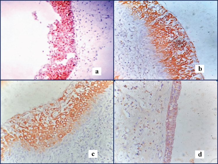 Distribution of staining: It was graded as: confined to only basal ...