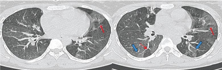a-c) HRCT images show nodular opacities along fissures and lymphatics ...