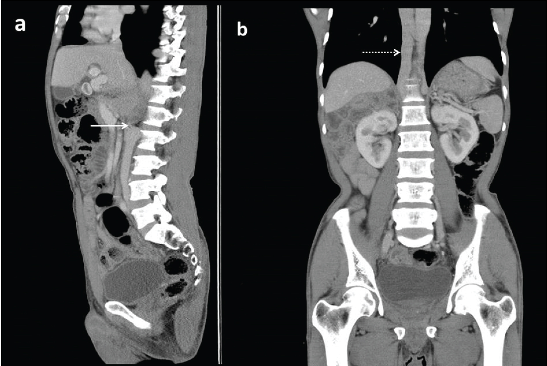 CT findings were consistent with heterotaxy syndrome with left ...