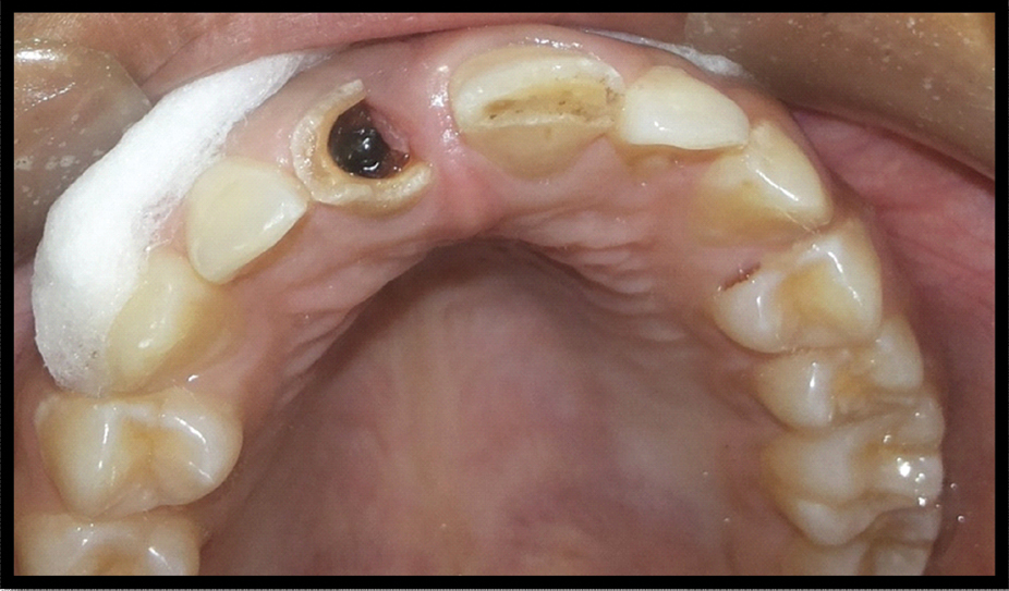 Preoperative IOPA radiograph of teeth #11, #21 revealing radiopaque ...