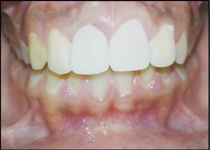 Three years follow up IOPA radiograph of teeth #11, #21 showing ...