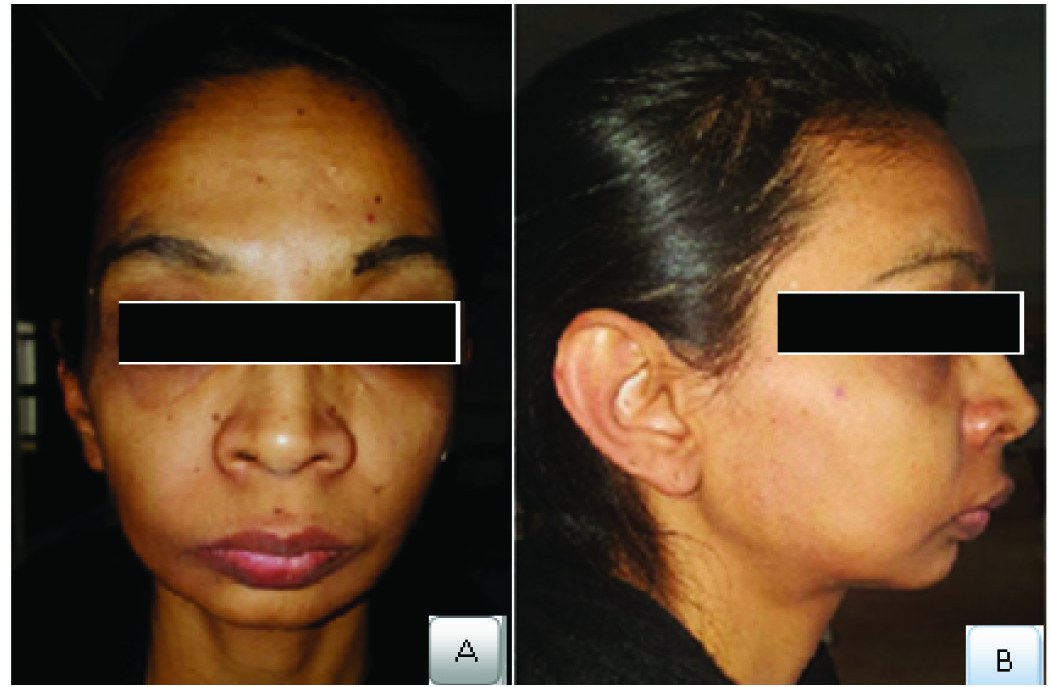 Retrognathia Correction