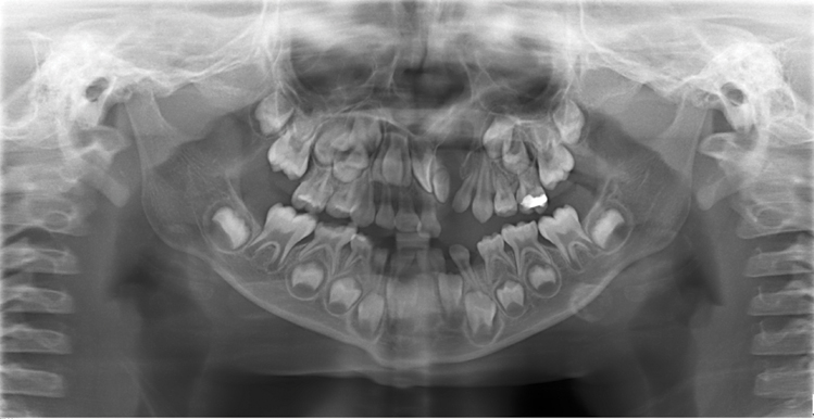 Panoramic radiograph showing connated teeth w.r.t 82 and 83 with ...