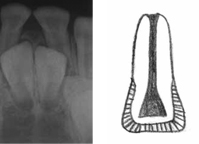 Bifid crown, single root: A large crown with a notch on the incisal ...