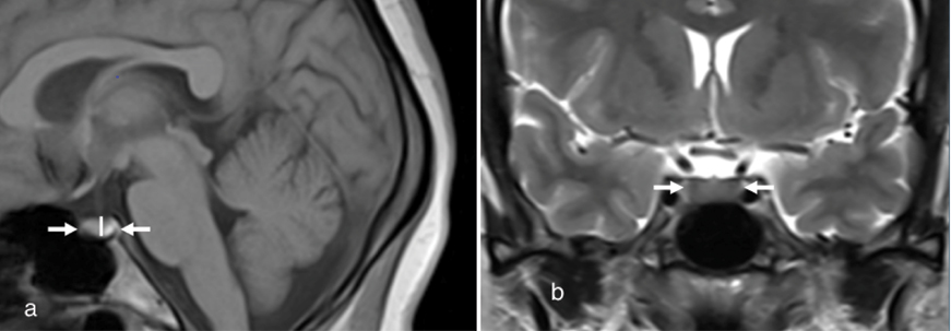 Normal Pituitary Mri T2