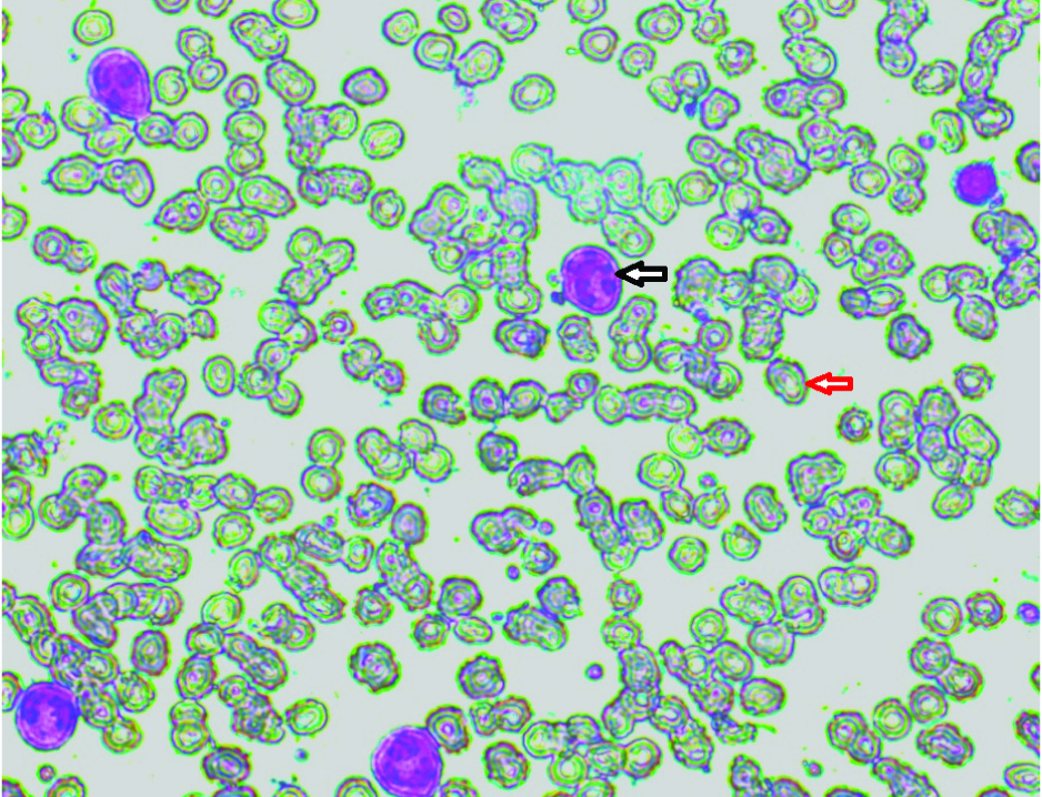 Peripheral smear showing macrocytes (red arrow) hypersegmented ...