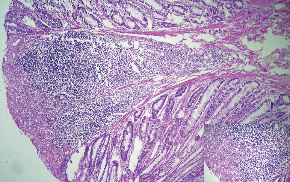 Intestinal Nodular Lymphoid Hyperplasia