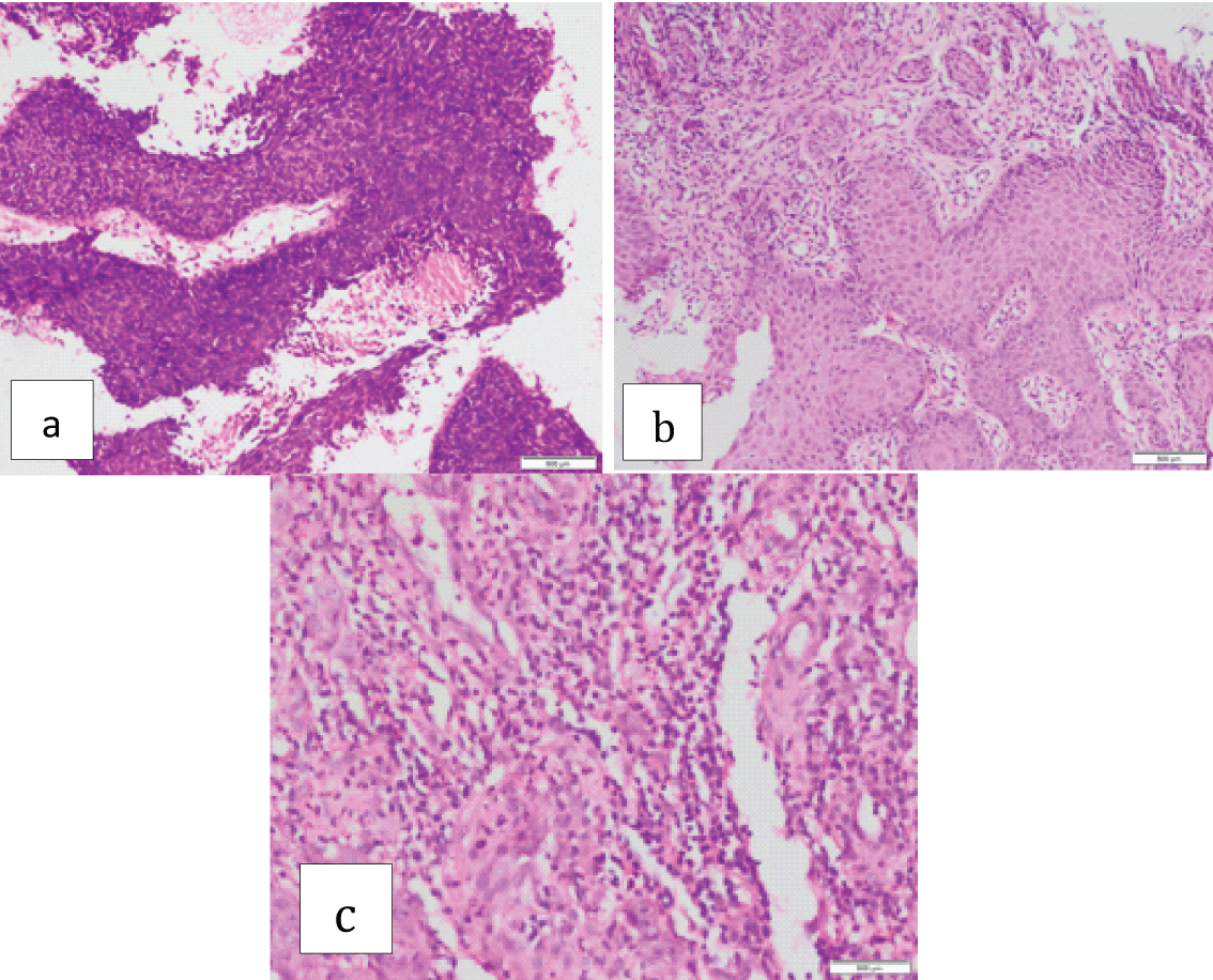 Low grade and high grade desmoplasia was observed in 54 (36.4%) and 94 ...