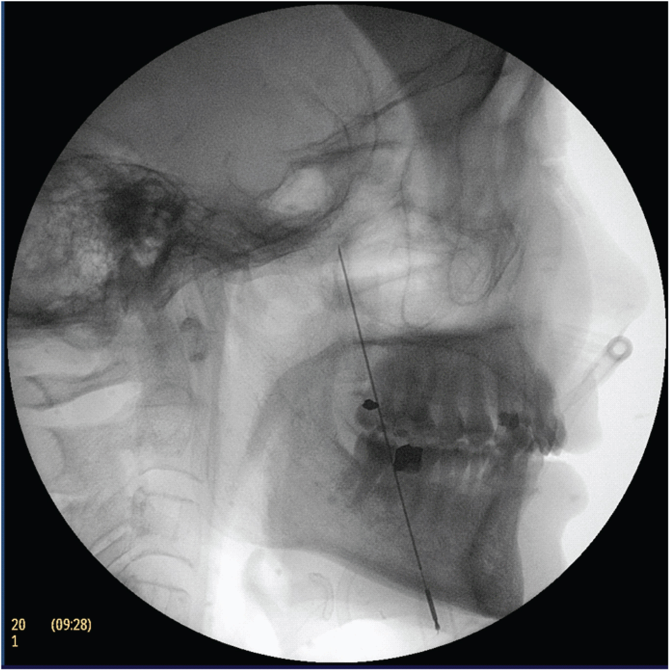 Pterygomaxillary Fissure Radiograph