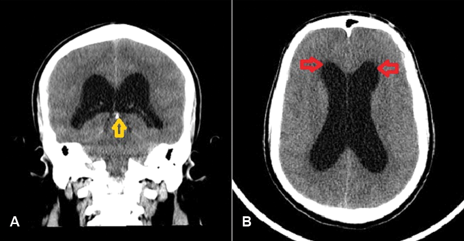 a) Plain CT Brain (coronal section) showing calcification in the falx ...
