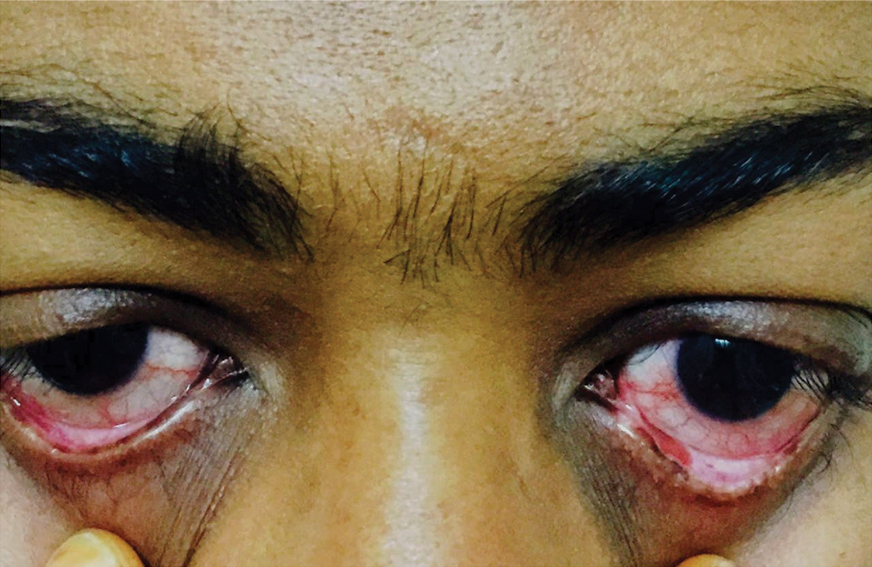 Clinical photograph at the time of consultation depicting SJS with ...