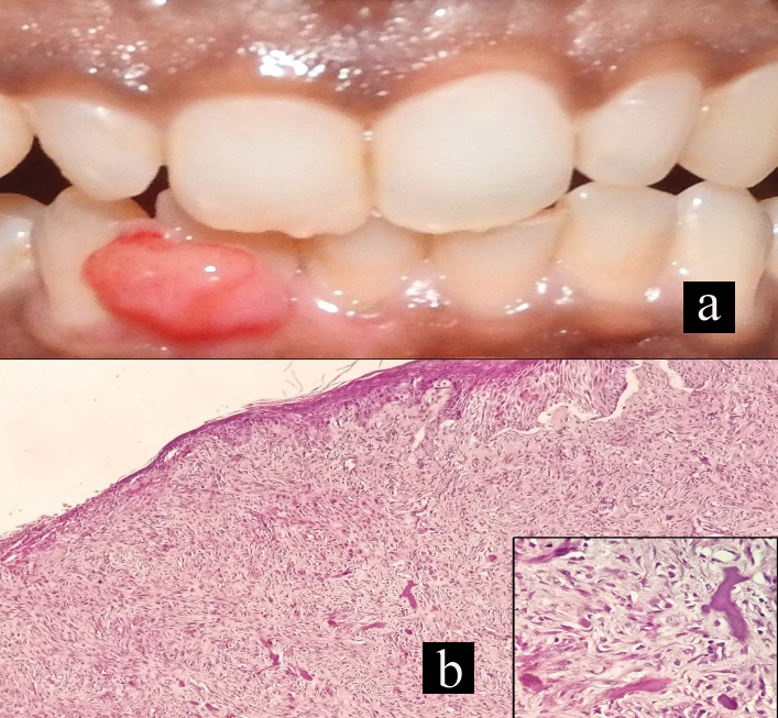 Inflammatory Fibrous Hyperplasia