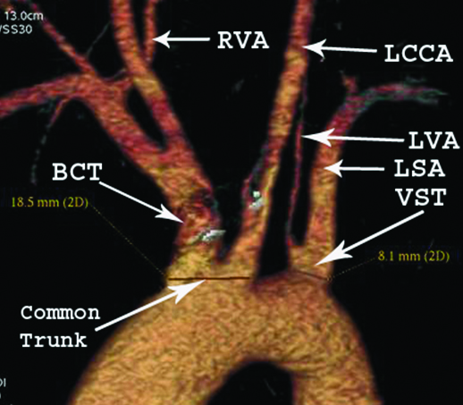 Brachiocephalic Trunk Cadaver