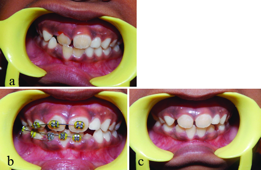 Group 2: Removable appliance (Hawley’s appliance with double cantilever ...