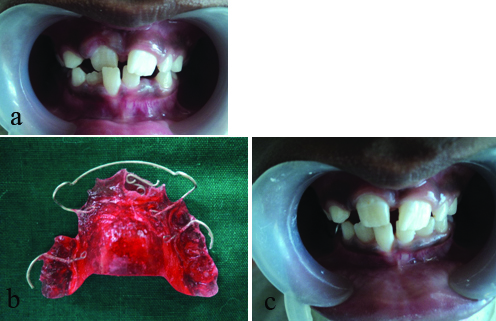 Group 3: Myofunctional appliance (Catlan’s appliance) case.