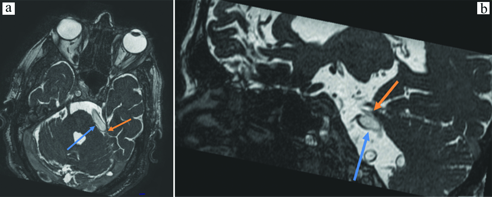 Benign Intracranial Hypertension