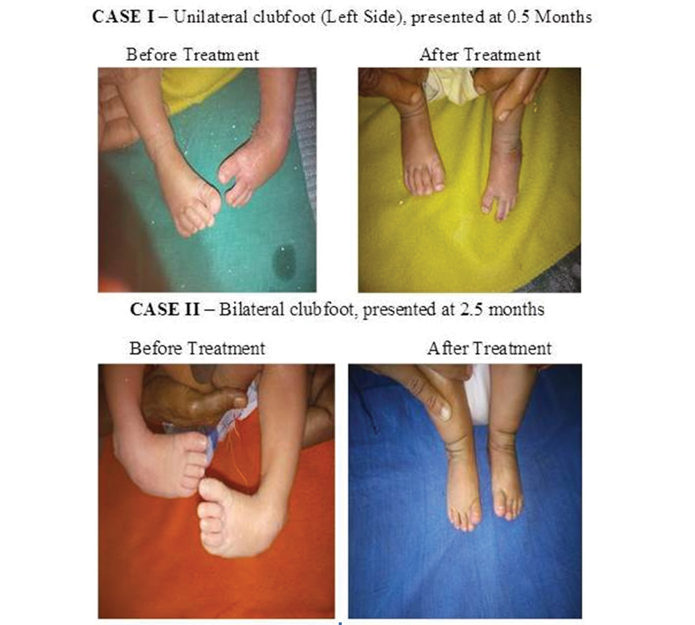 Club Foot Treatment