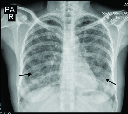Chest X-ray showing ground glass opacities in both lungs.