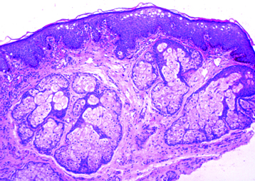 Sebaceous Hyperplasia Histology