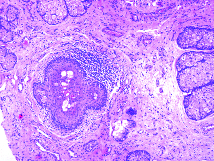 Sebaceous Hyperplasia Histology